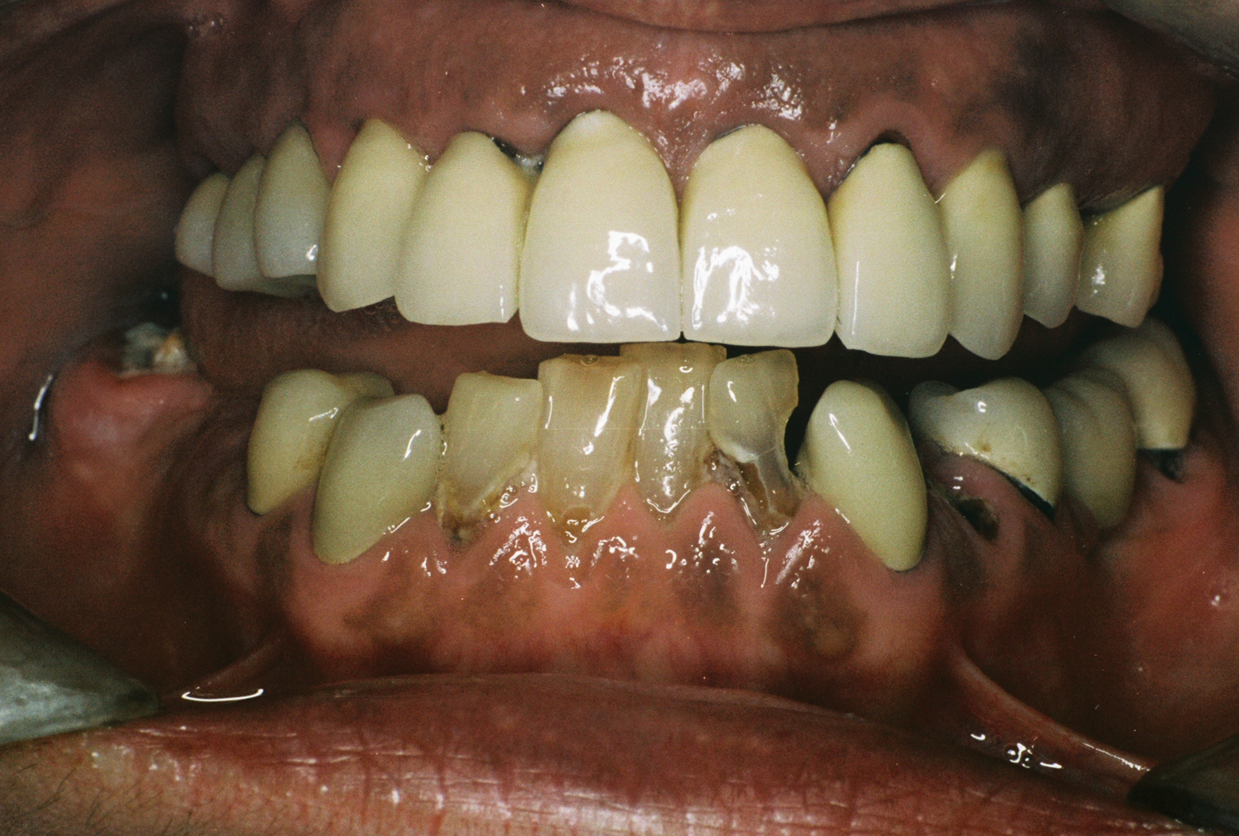 Teeth-in-an-Hour Chicago IL | Dental Implants